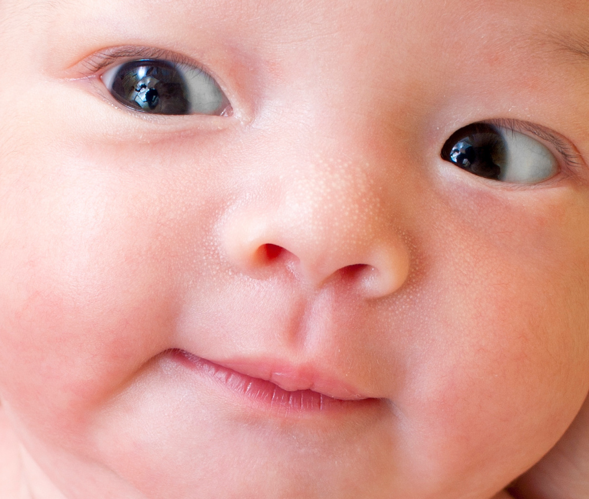 Common Newborn Rashes - Pediatrics West