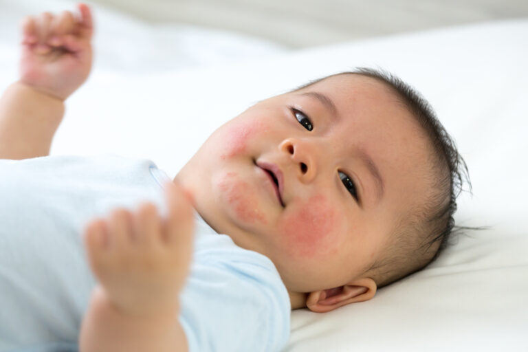 Common Newborn Rashes - Pediatrics West